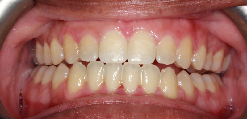 Invisalign, Braces Santa Barbara CA